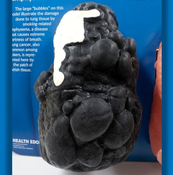 Breathless Brian Smoker's Lungs Comparison Model - Primo Prevention